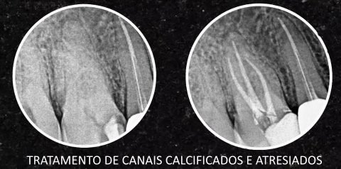 O que é um Canal Calcificado - Endodontia com Microscopia