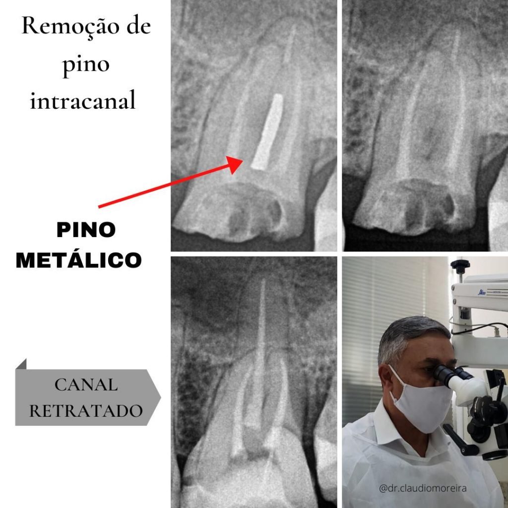 Remoção de Pinos Intrarradiculares em Dentes Tratados de Canal ...